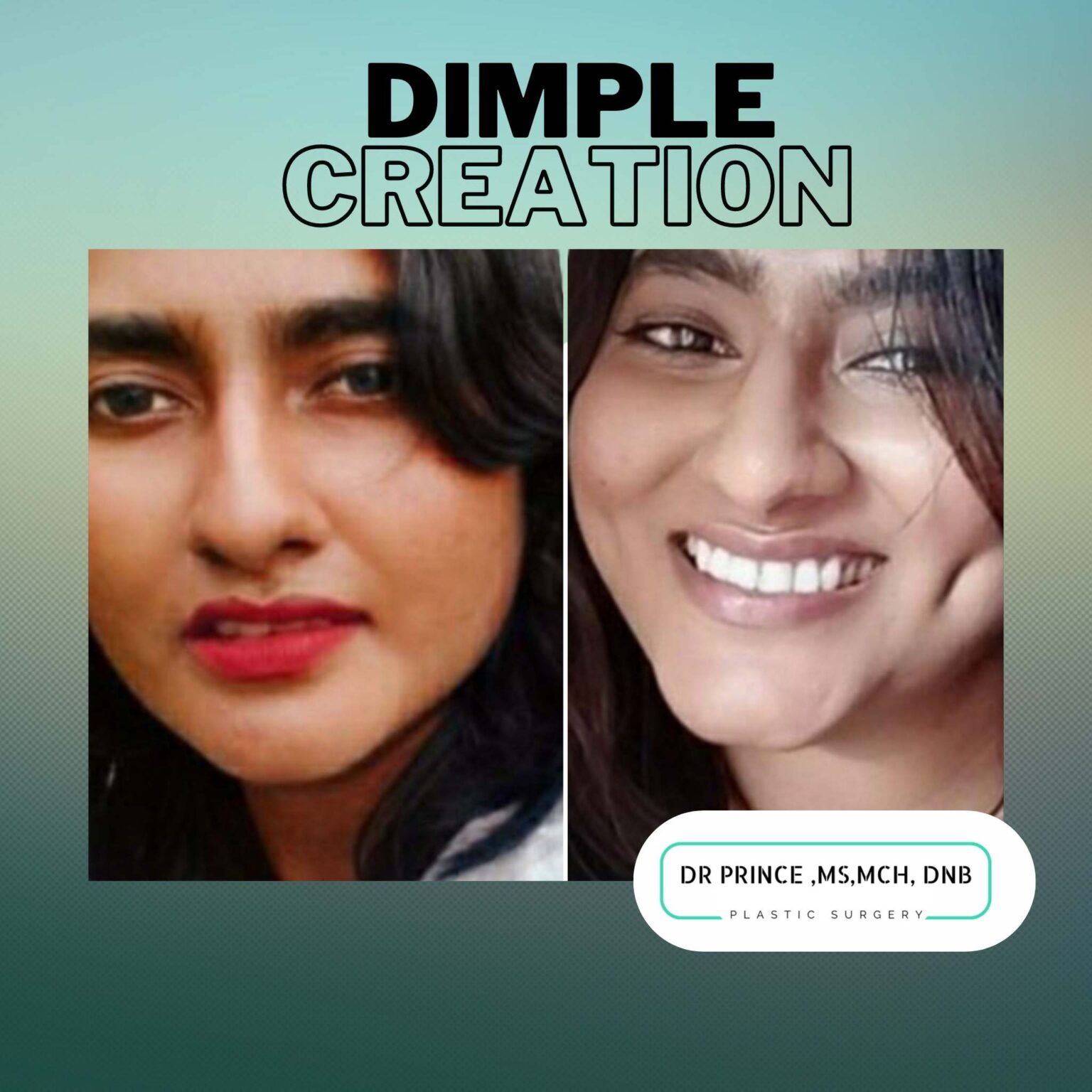 Dimple creation - topplasticsurgery