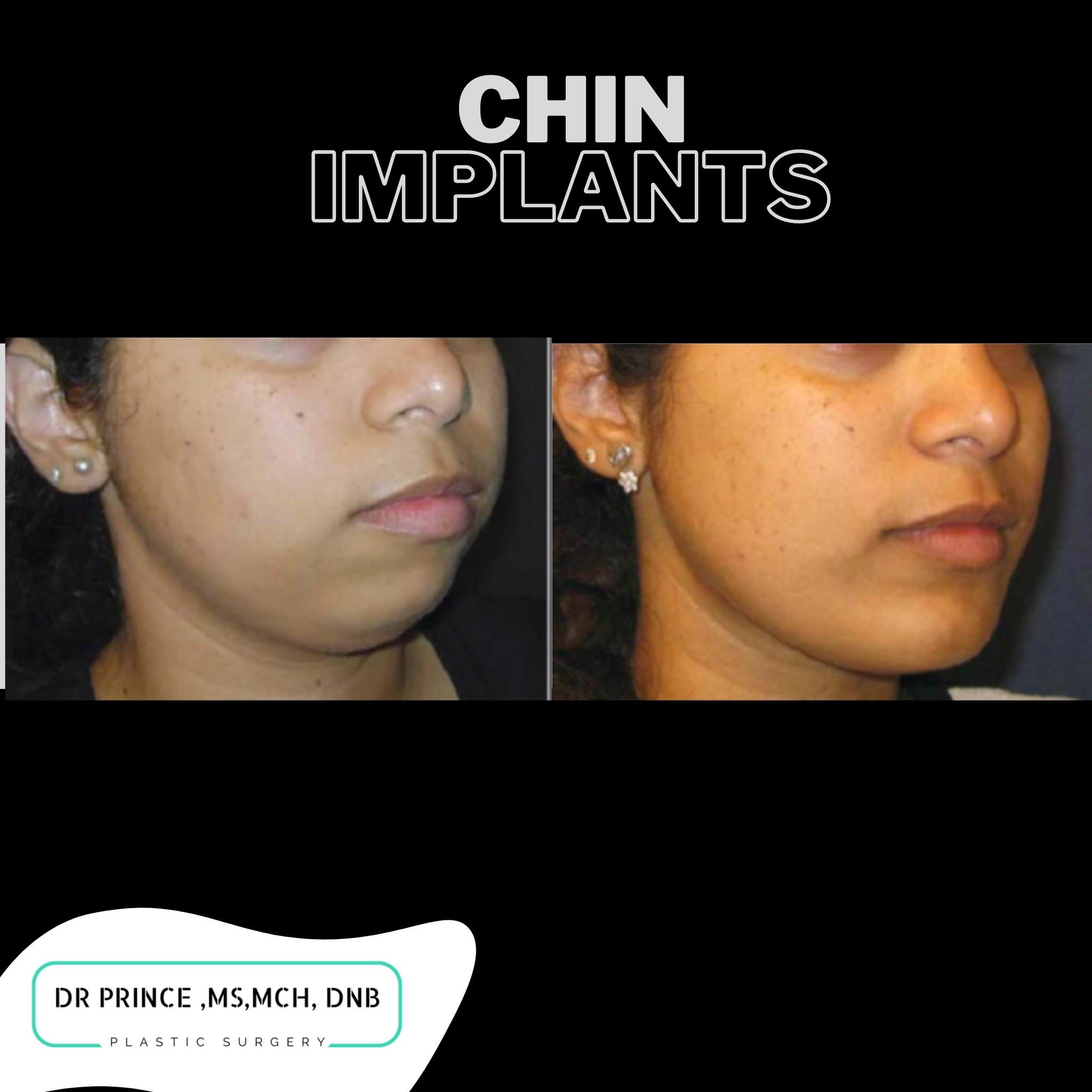 #1 Chin augmentation with implants in thrissur| Dr Prince
