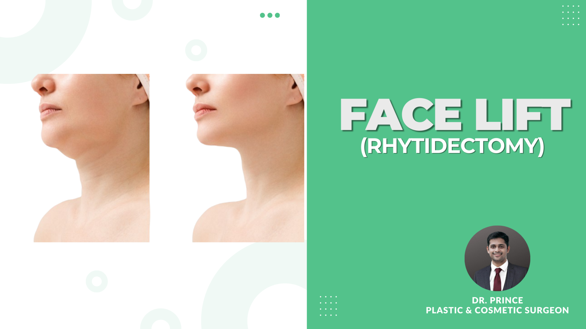 Timeless Elegance: The Art of Facial Rejuvenation through Facelift ...