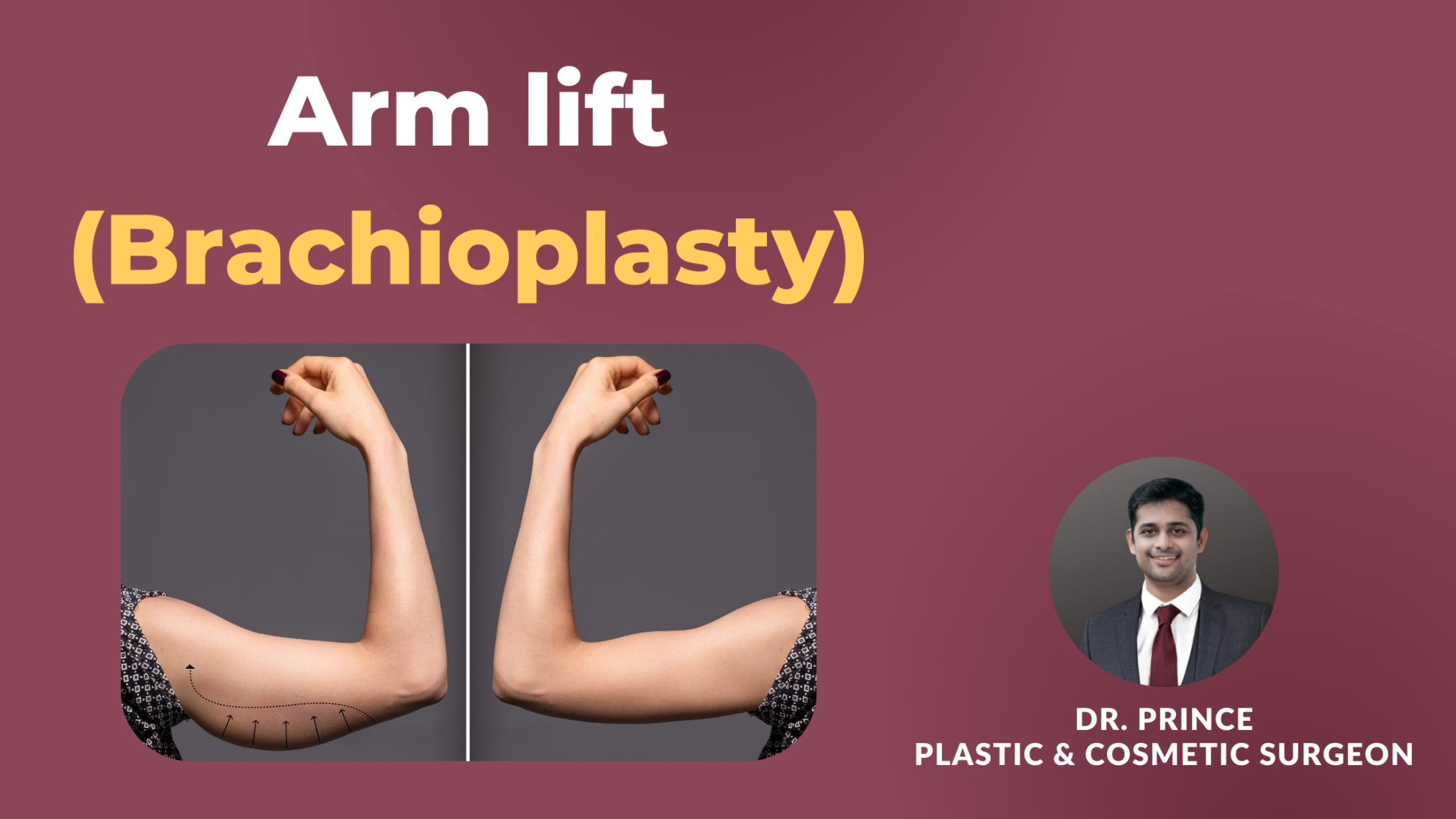 Sculpting Elegance: A Comprehensive Guide to Arm Lift (Brachioplasty ...