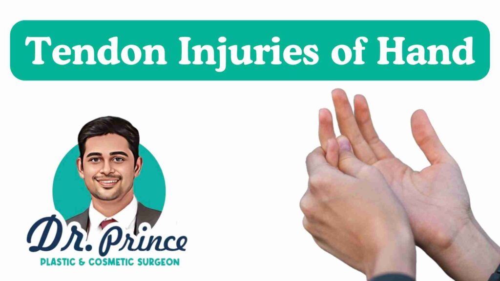 Tendon Injuries of Hand - topplasticsurgery