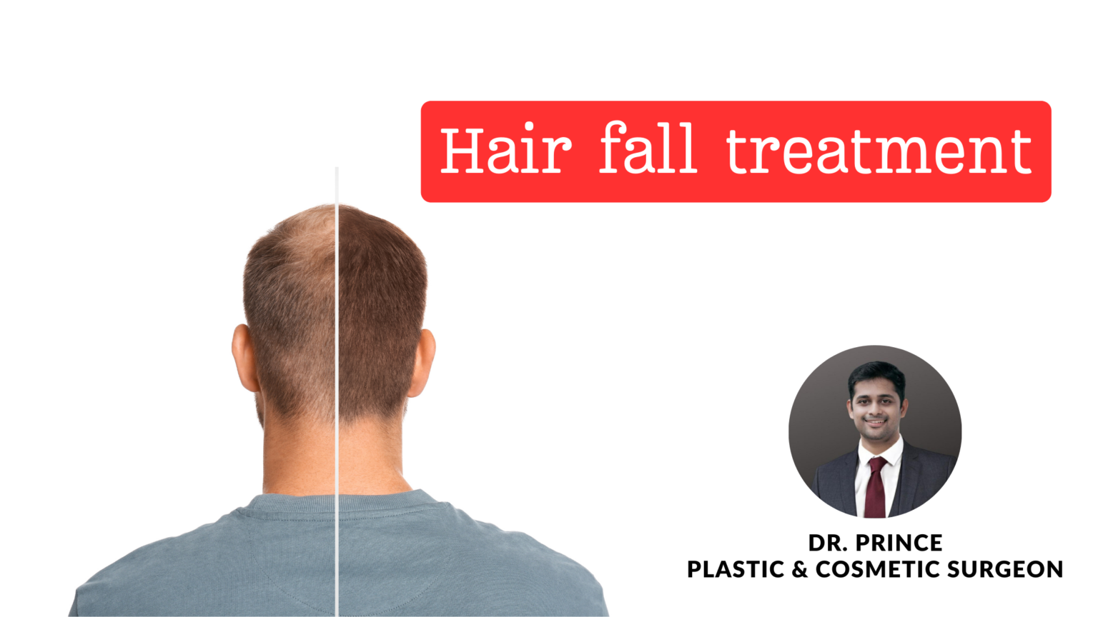 Hair fall treatment Title: Taming Tresses: A Comprehensive Guide to ...