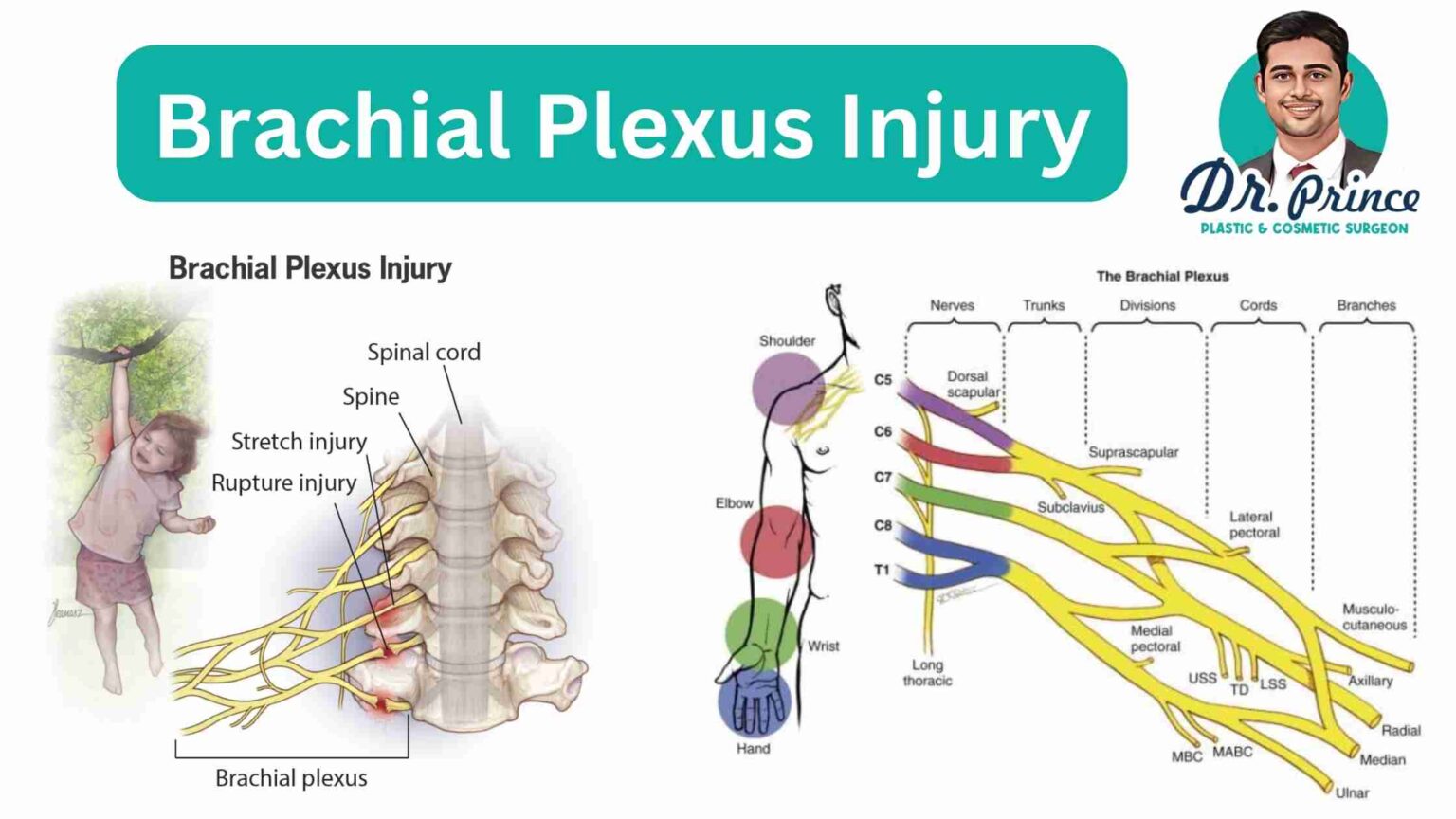 Brachial Plexus Injury - topplasticsurgery