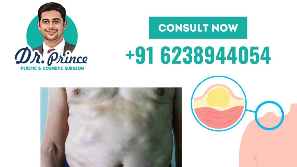 Comprehensive Guide on Multiple Lipomas and Lipoma Removal Surgery in ...